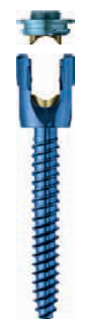 HTS Code for pangea dual core spine screw